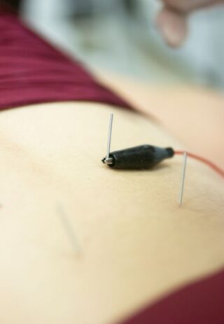 IMS Dry Needling – REVIVE REHAB